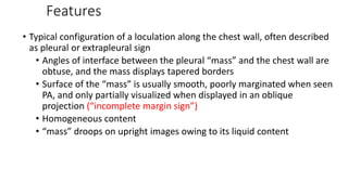 Pleural effusion(X-ray Findings) | PDF