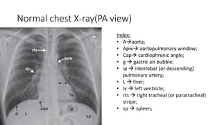 Pleural effusion(X-ray Findings) | PDF