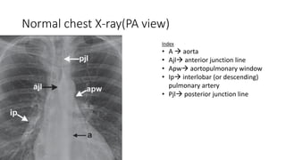 Pleural effusion(X-ray Findings) | PDF