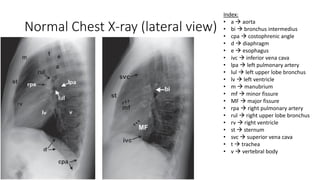 Pleural effusion(X-ray Findings) | PDF