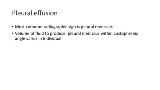 Pleural effusion(X-ray Findings) | PDF