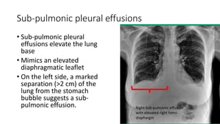 Chest X Ray Pleural Effusion Interpretation