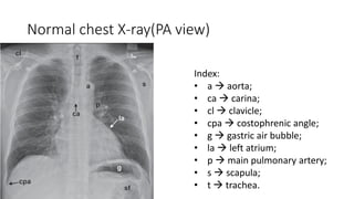 Chest X Ray Pleural Effusion Interpretation