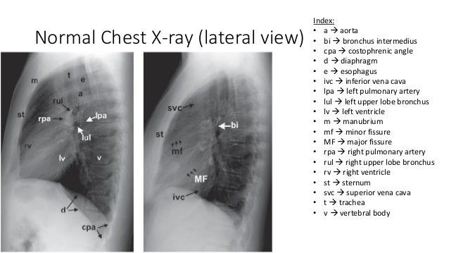 Pleural effusion(X-ray Findings)