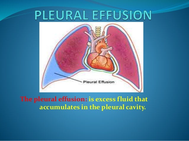 Pleural effusion