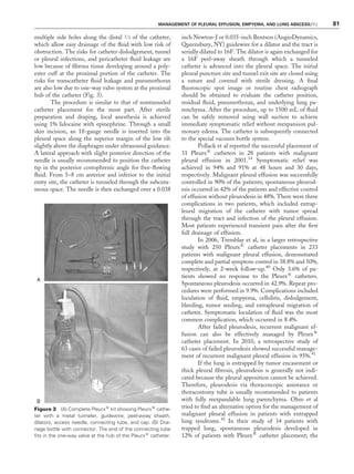 Pleural effusion | PDF