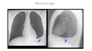 Pleural effusion basics | PPT