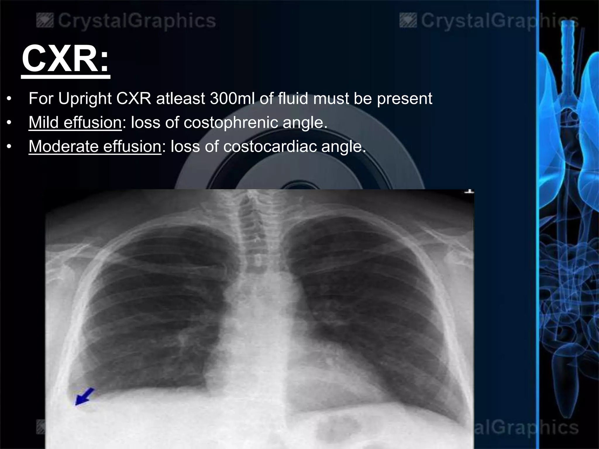 Pleural effusion | PPTX