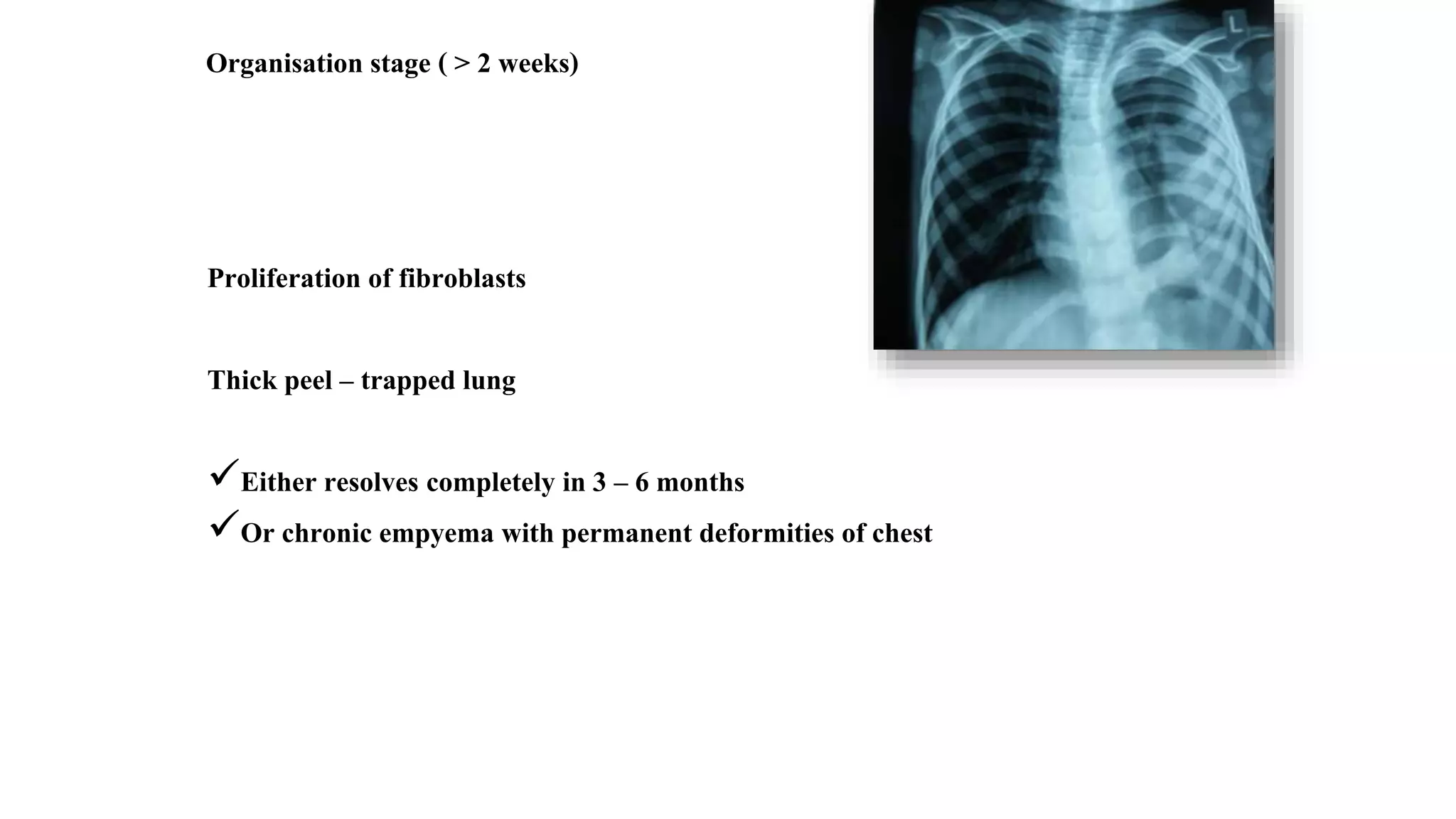 Pleural effusion in children | PPTX