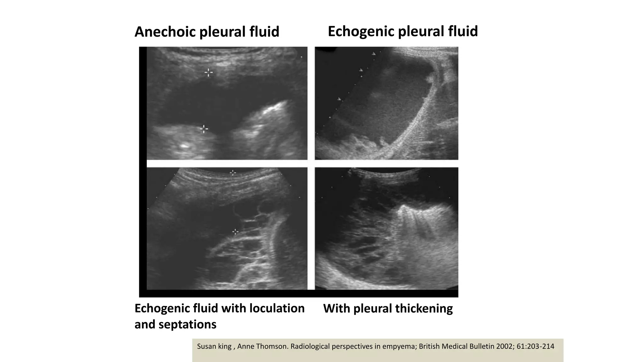 Pleural effusion in children | PPTX