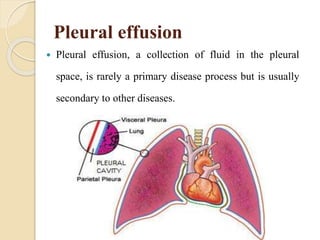 Pleural effusion | PPT