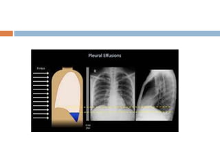 IMAGE BASED QUANTIFICATION OF PLEURAL EFFUSION | PPTX