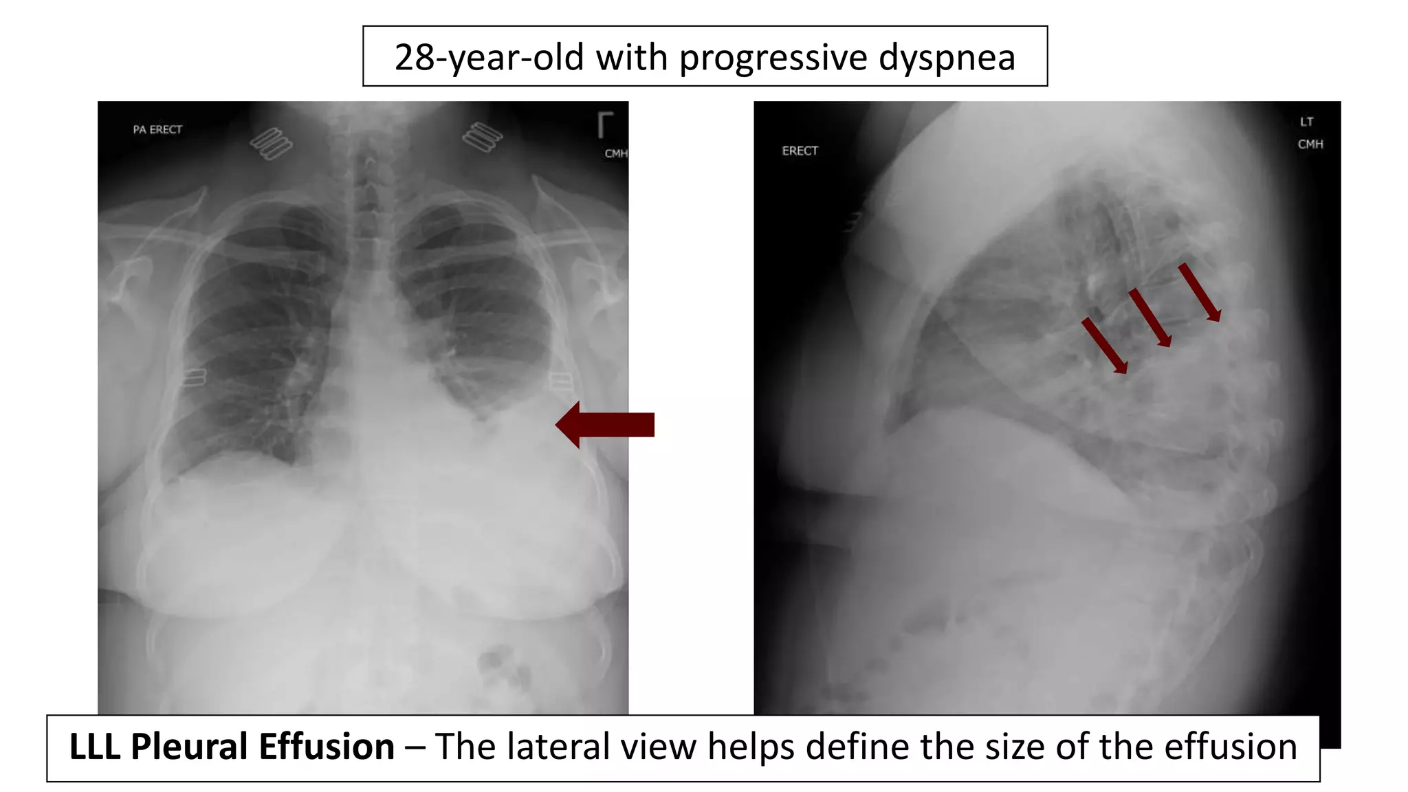 EMGuideWire's Radiology Reading Room: Pleural Effusions | PPTX