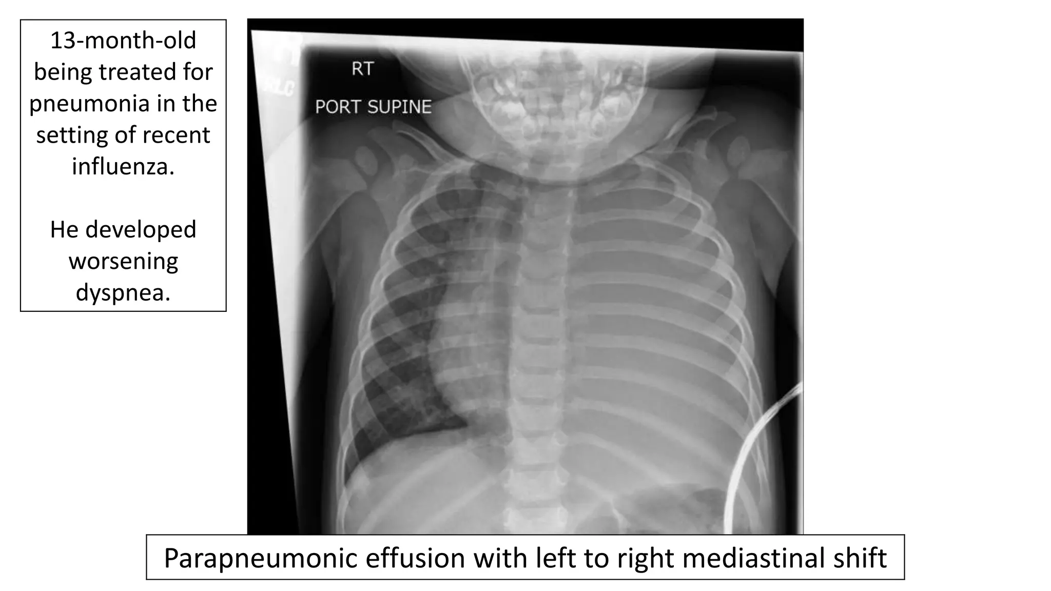 EMGuideWire's Radiology Reading Room: Pleural Effusions | PPTX