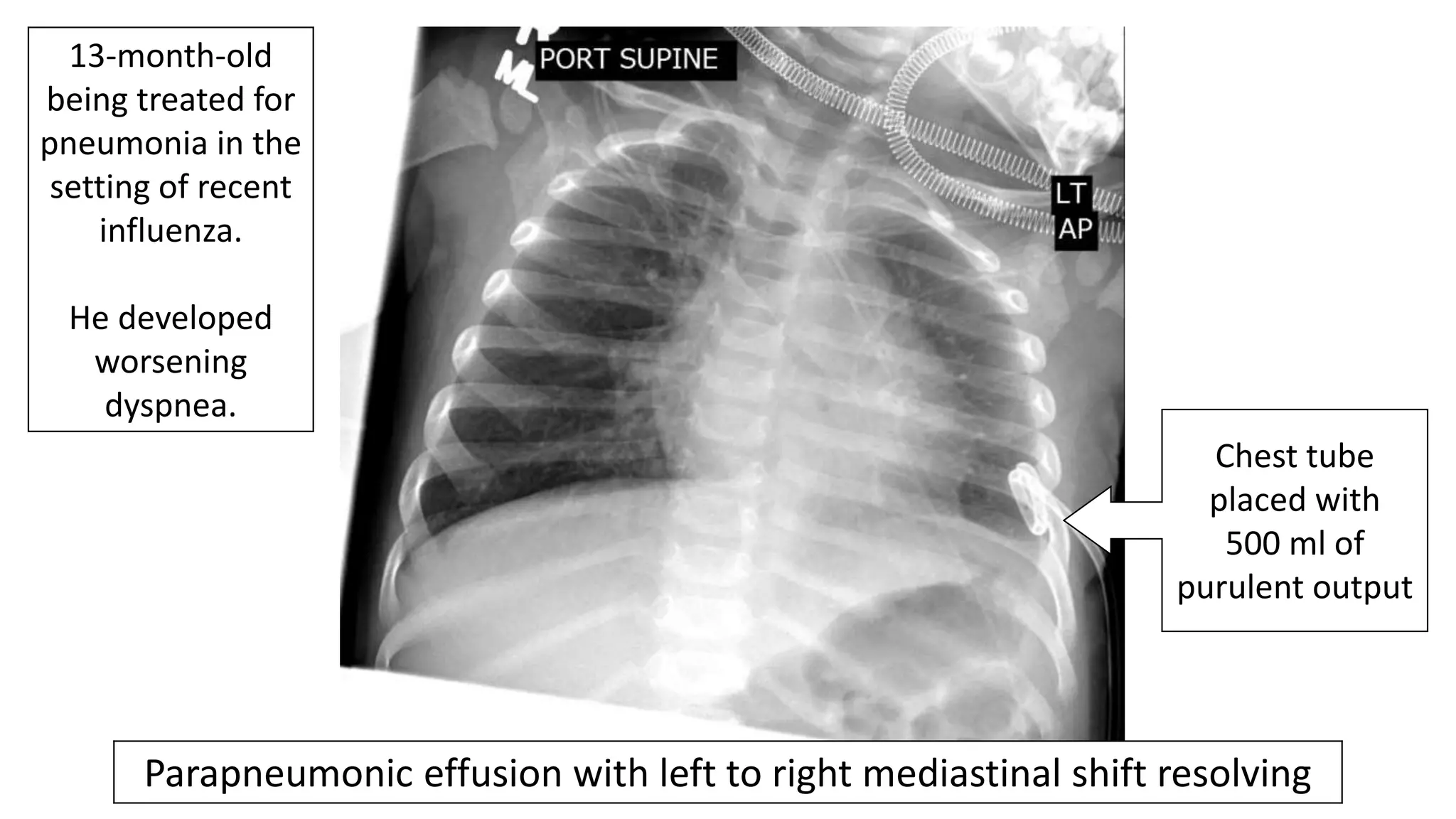 EMGuideWire's Radiology Reading Room: Pleural Effusions | PPTX