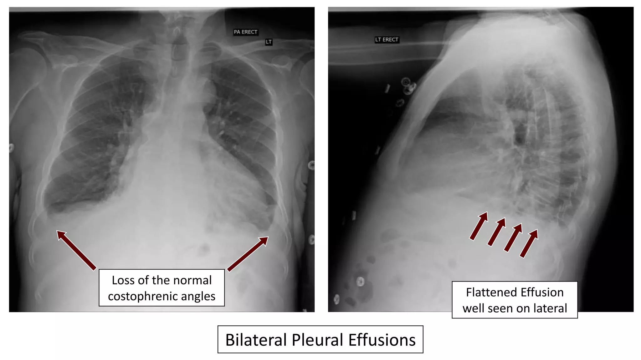 EMGuideWire's Radiology Reading Room: Pleural Effusions | PPTX