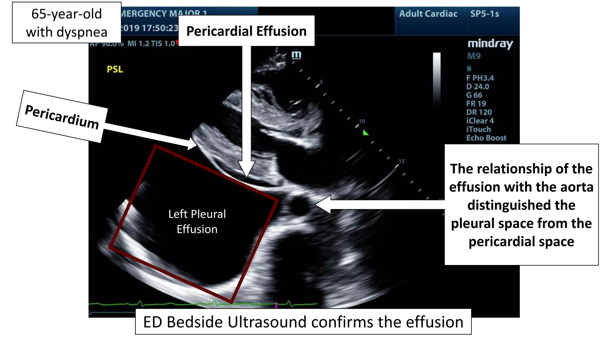 EMGuideWire's Radiology Reading Room: Pleural Effusions | PPTX