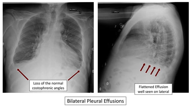 EMGuideWire's Radiology Reading Room: Pleural Effusions | PPTX