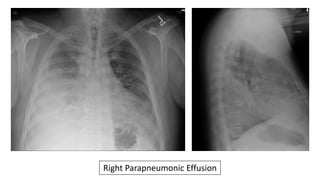 EMGuideWire's Radiology Reading Room: Pleural Effusions | PPTX