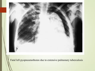 Pleural effusion - Etiopathogenesis, Clinical features, Advances in ...