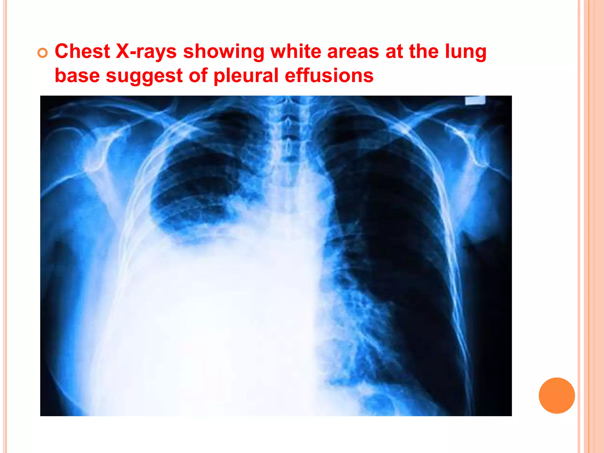 Pleural effusion & nursing care | PPTX
