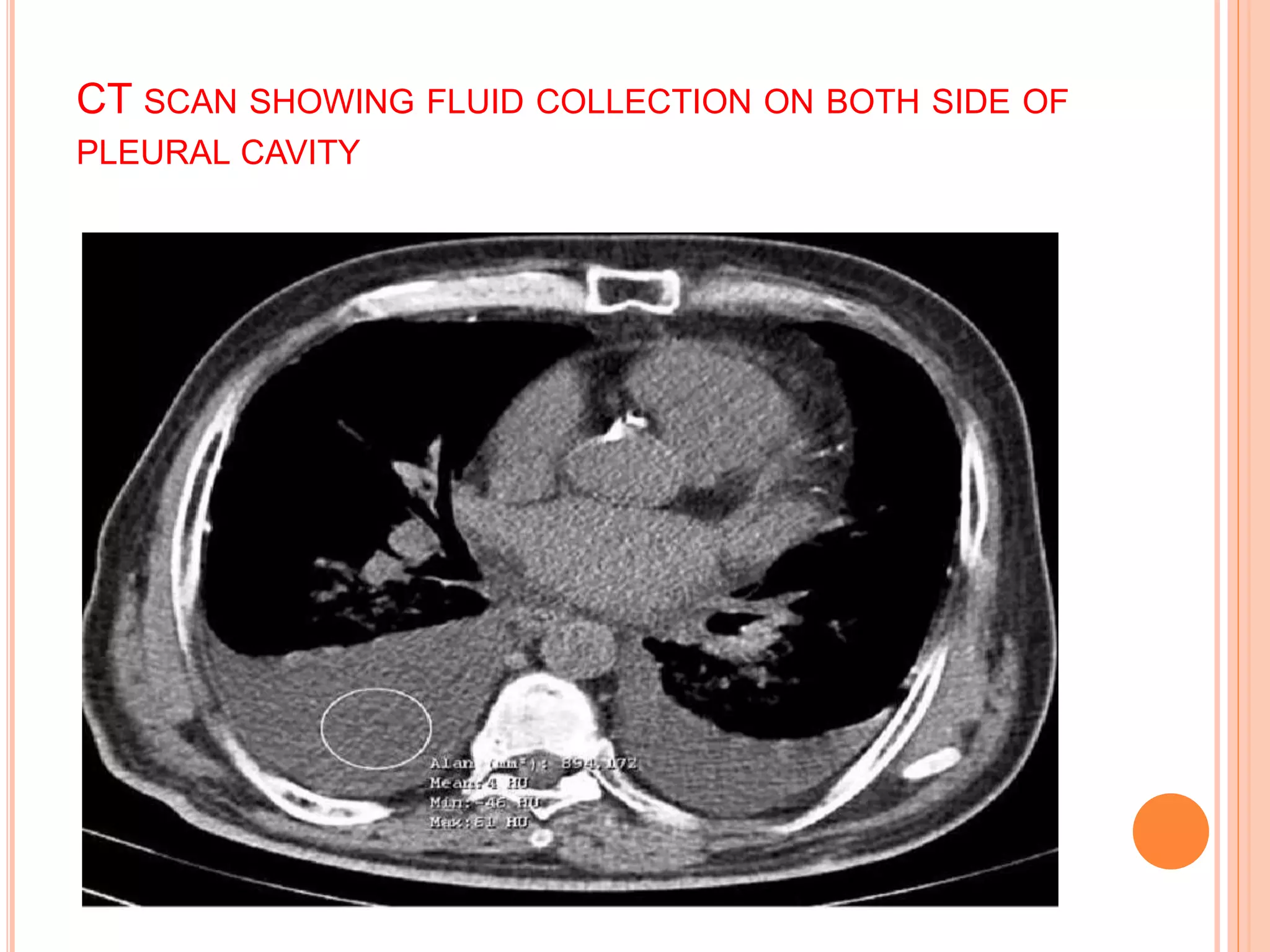 Pleural effusion & nursing care | PPTX