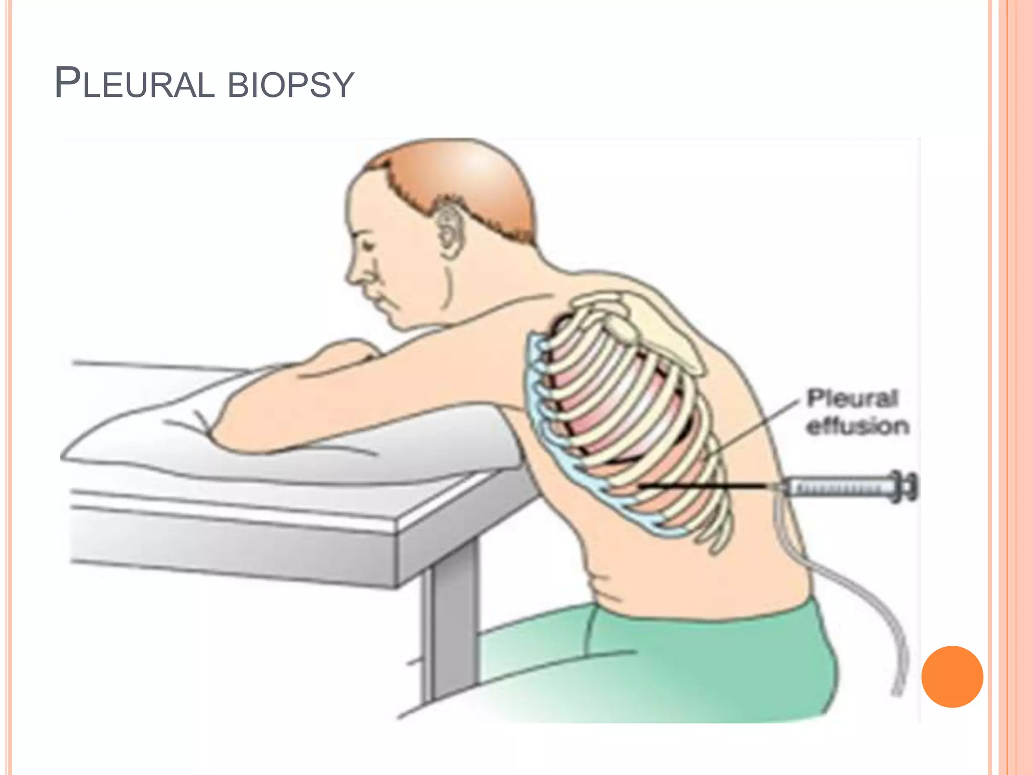 Pleural effusion & nursing care | PPTX