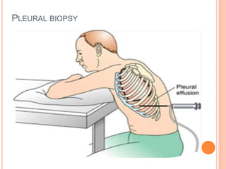 Pleural effusion & nursing care | PPTX