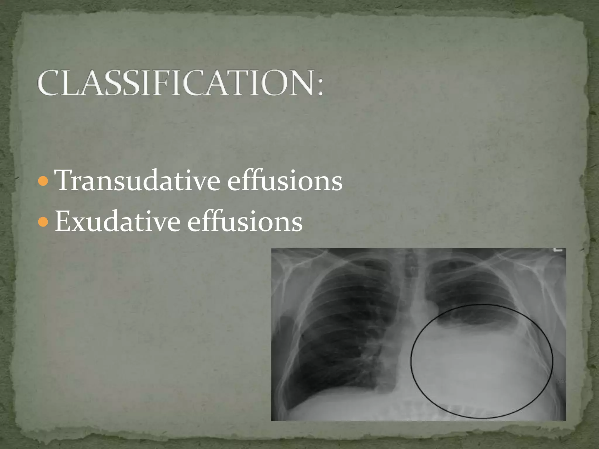 Pleural effusion Seminar Presentation | PPTX