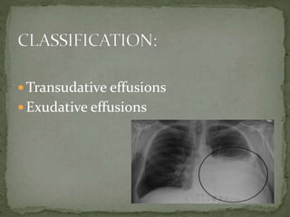 Pleural effusion Seminar Presentation | PPTX