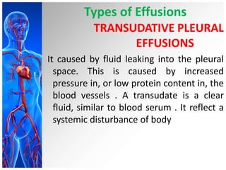 Pleural effusion | PDF