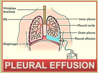 PLEURAL EFFUSION.pptx
