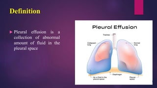 pleural effusion.pptx