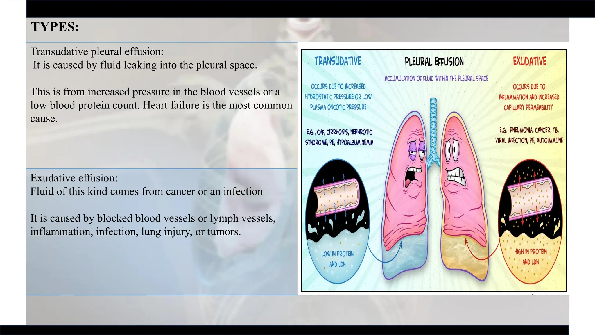 PLEURAL EFFUSION, TYPES AND MANAGEMENT.pdf