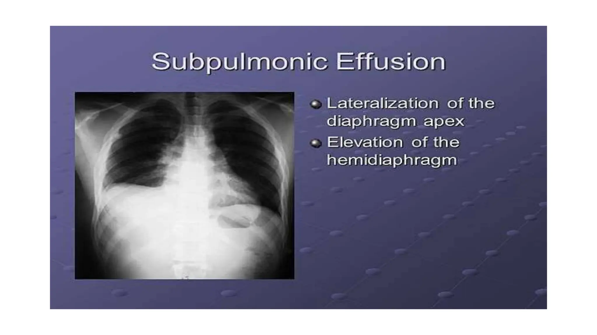 pleural effusion radiological aspects ppt | PPTX