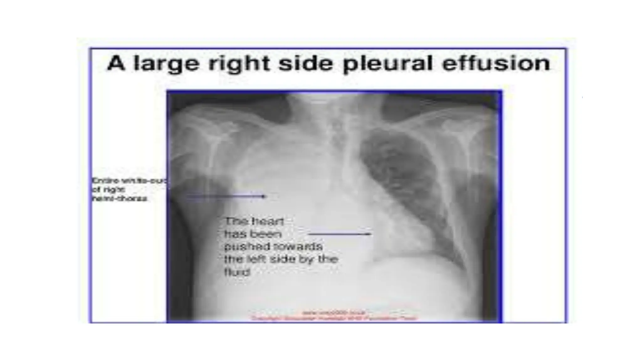 pleural effusion radiological aspects ppt | PPTX