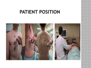 Ultrasound of Pleural effusion and ultrasound finding.pptx