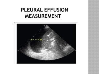 Ultrasound of Pleural effusion and ultrasound finding.pptx
