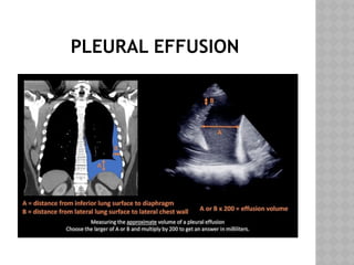 Ultrasound of Pleural effusion and ultrasound finding.pptx