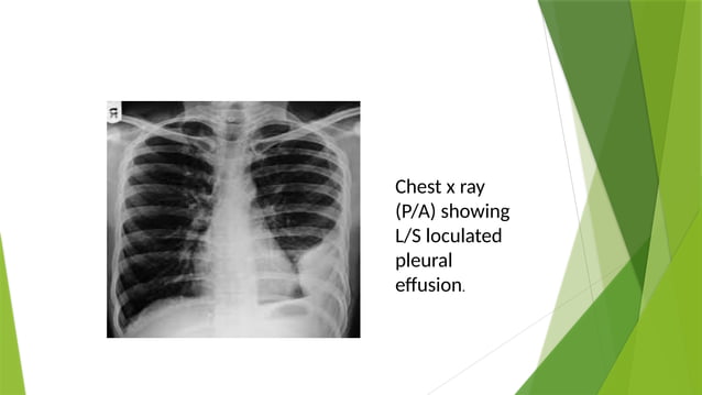 Non Malignant Pleural effusions and TB effusion.pptx