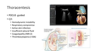 Pleural effusion 18022019 | PPTX