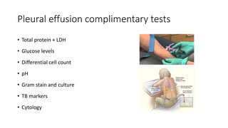 Pleural effusion 18022019 | PPTX