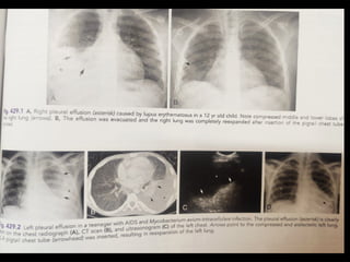 In pediatrics pleural effusion and empyema.pptx