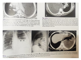 In pediatrics pleural effusion and empyema.pptx