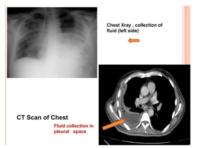 pleural effusionand empyema by RaafatAl-Awadhi(1).pptx