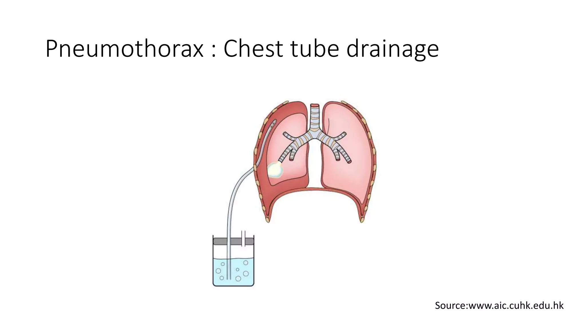 Parapneumonic effusion and Pneumothorax | PPTX