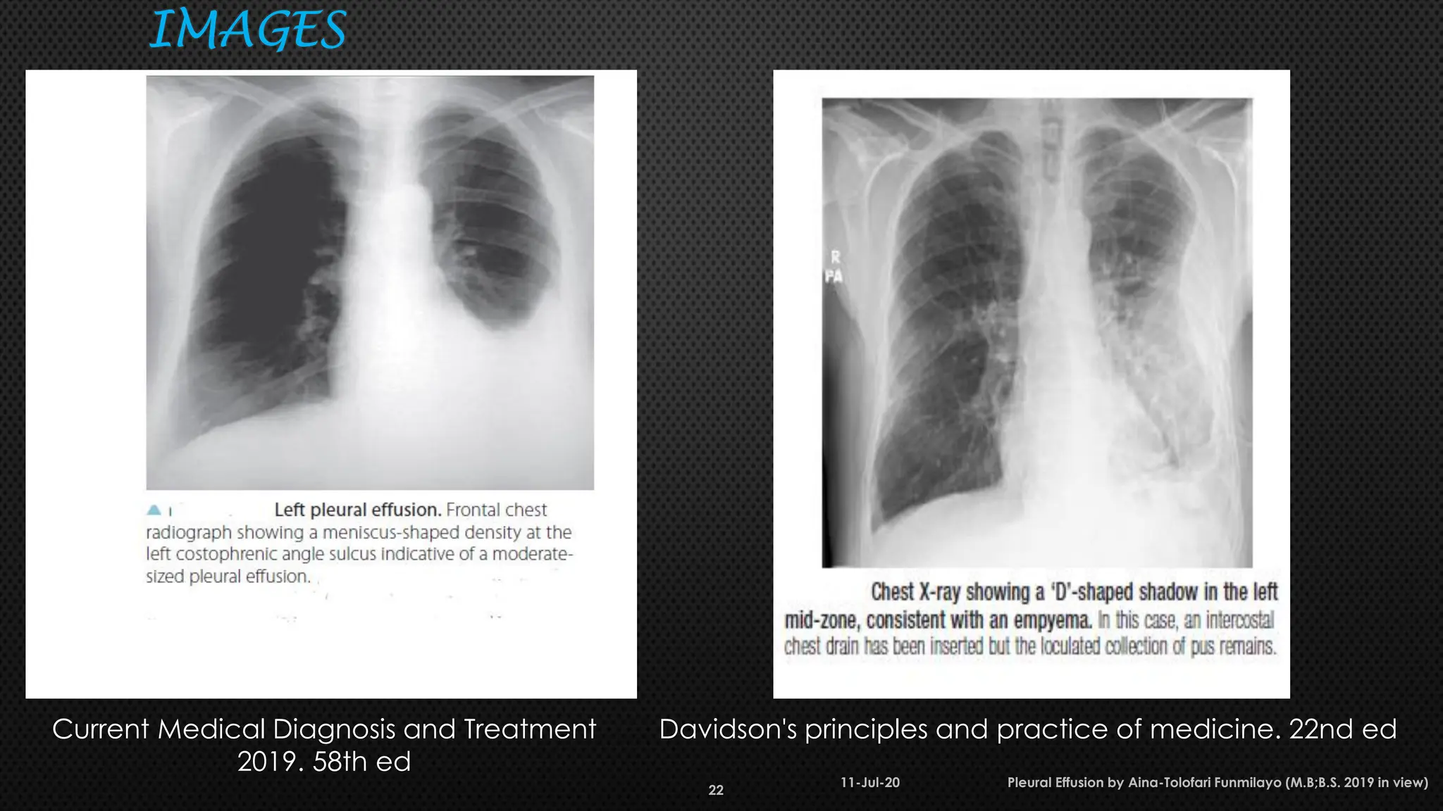 Pleural effusion by Aina- Tolofari Funmilayo Ayodeji | PDF
