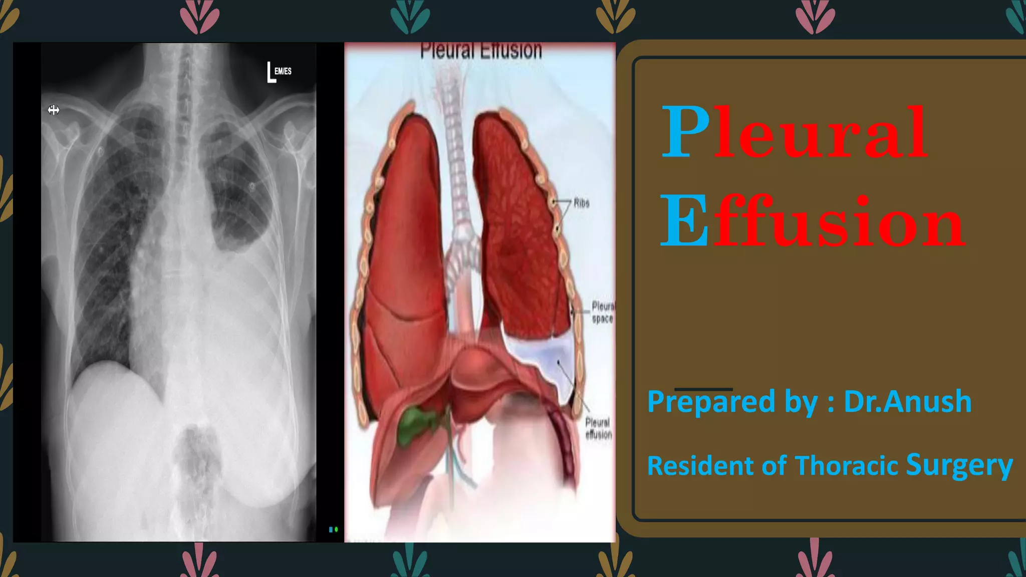 Pleural effusion dr.anush | PDF