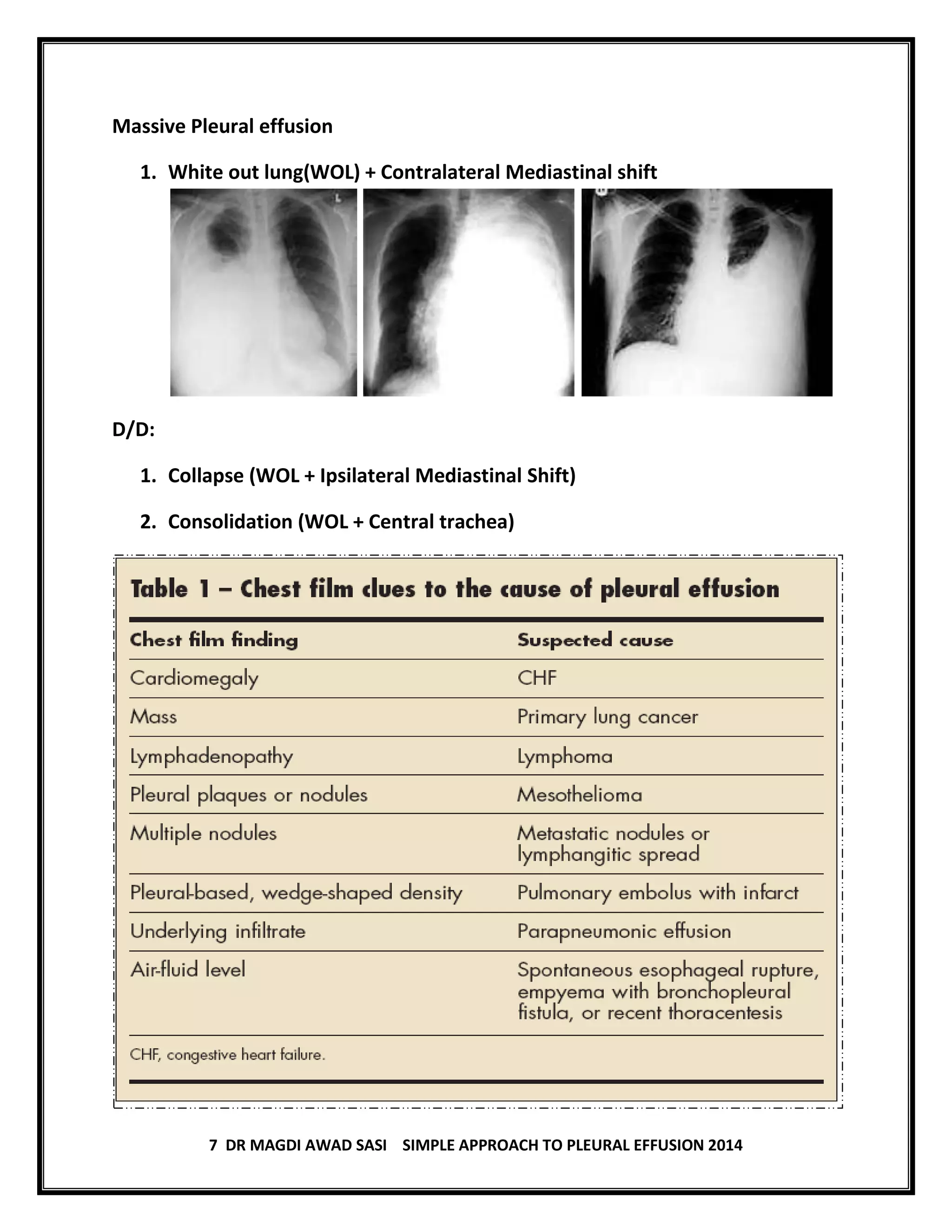 Pleural effusion dr magdi sasi | DOCX