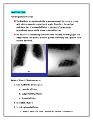 Pleural effusion dr magdi sasi | DOCX